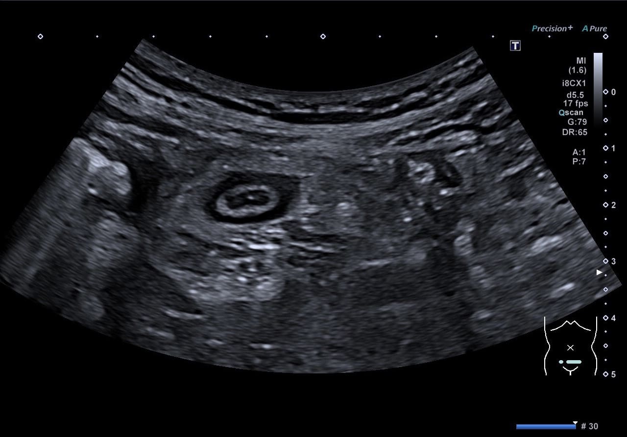 Akute Appendizitis - EUS and more