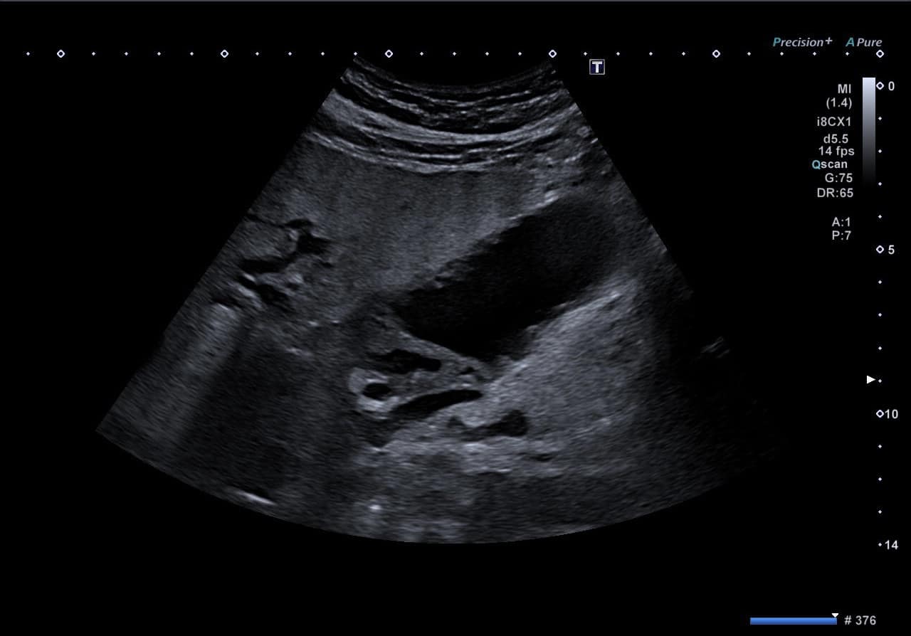 Afferent-Loop-Syndrom 1/2 - EUS and more