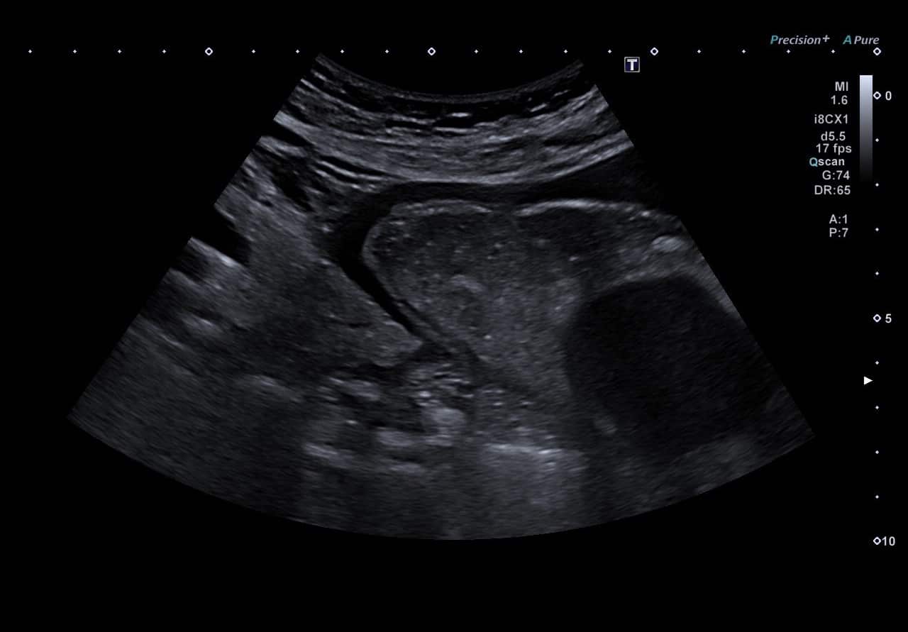 Gastrointestinaler Stromatumor - EUS and more