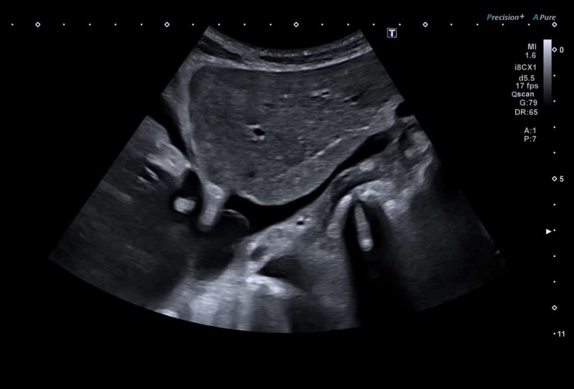 Valvula Eustachii - EUS and more