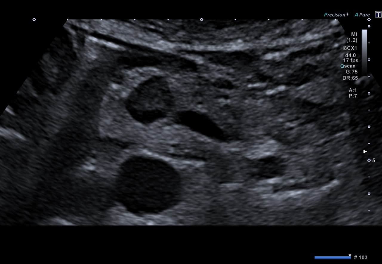 Insulinom des Pankreas - EUS and more
