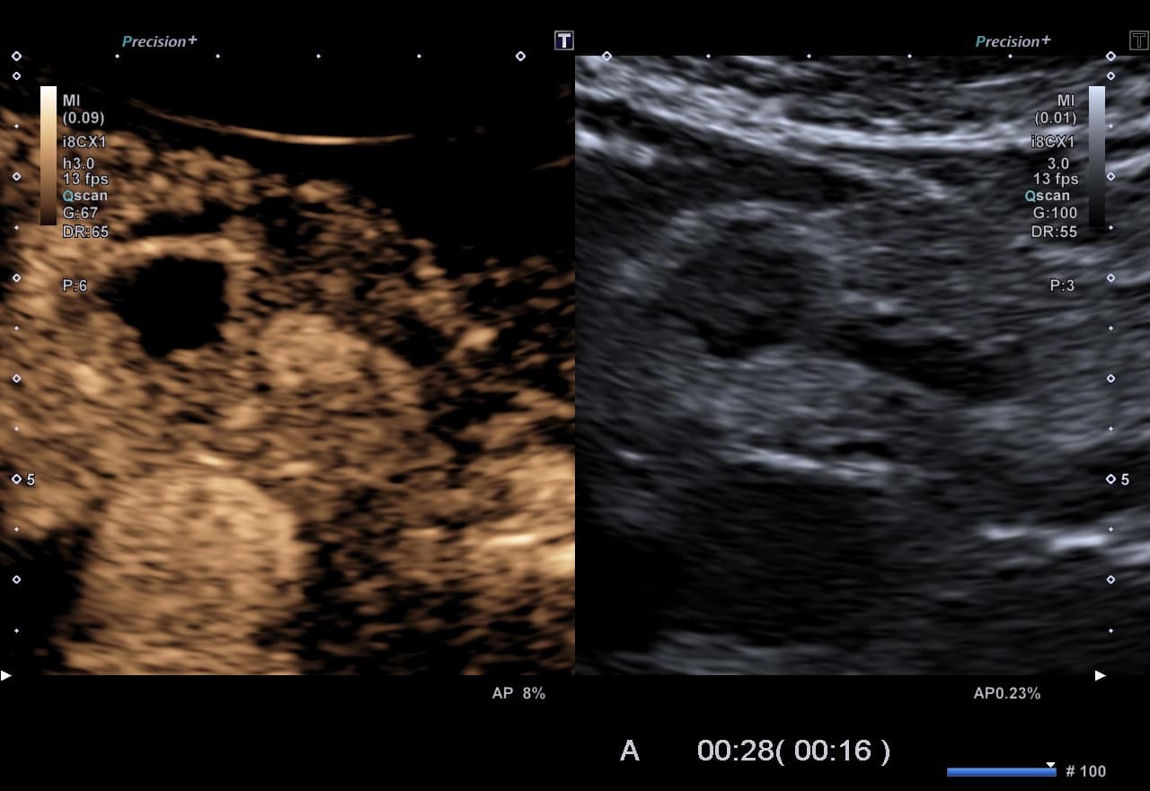 Insulinom des Pankreas - EUS and more