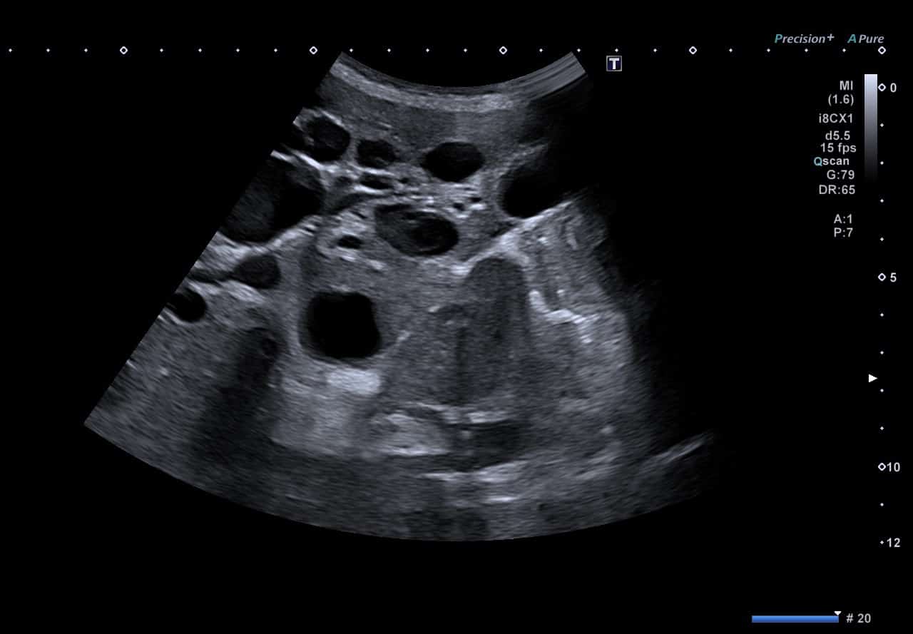 Infizierte Leberzyste - EUS and more